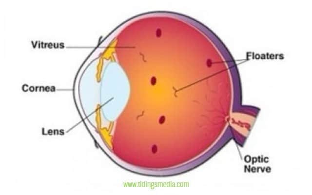 Black Spots in Vision, Sudden, Not Floaters, Pictures, Causes, Get Rid ...