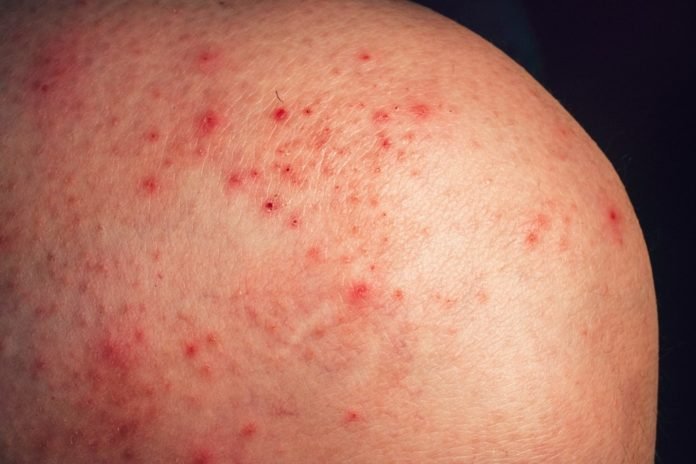 Red Spots on Legs, Feet, Dots, Patches, Not Itchy, Pictures, Causes ...